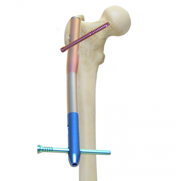 A2fn Femur Nail Short